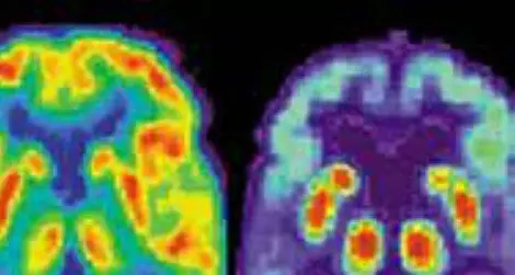 Der Gehirnscan rechts zeigt Alzheimer-Schäden.