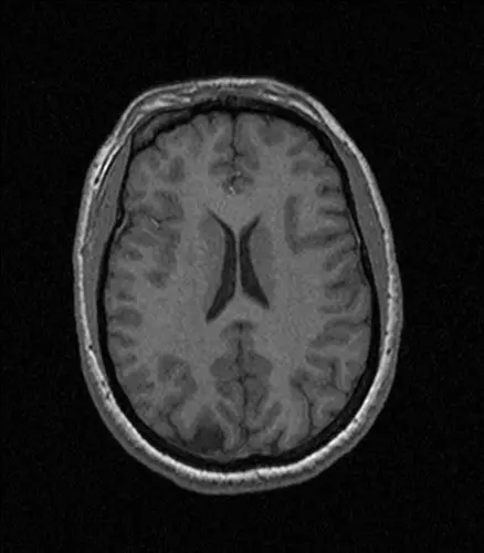 صورة بالرنين المغناطيسي الوظيفي للدماغ.