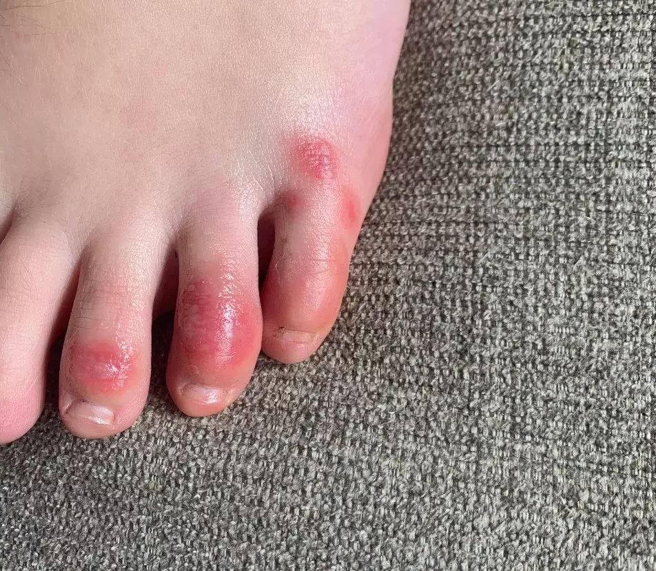 A bal láb képe, amelyen a kis lábujjakon fagycsípésre emlékeztető vörös bőrirritáció látható