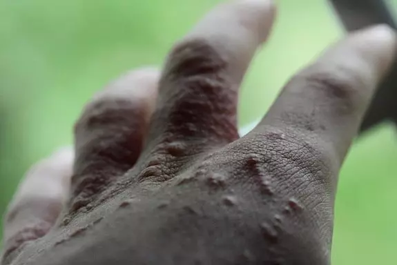 Per evitar les erupcions d'heura verinosa, feu que la saba de la planta brilli