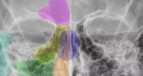 Tämä röntgenkuva ihmisen kallosta