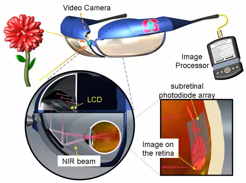 Чи може ця система Bionic Vision відновити зір?