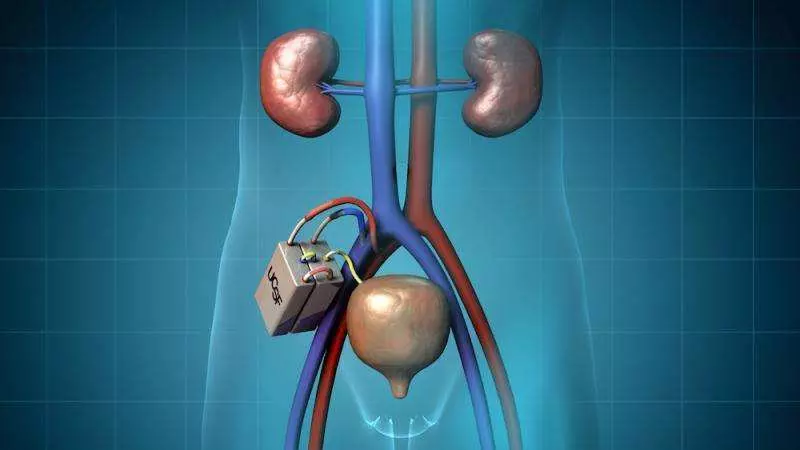 Una il·lustració digital de com és el dispositiu renal bioartificial dins del cos