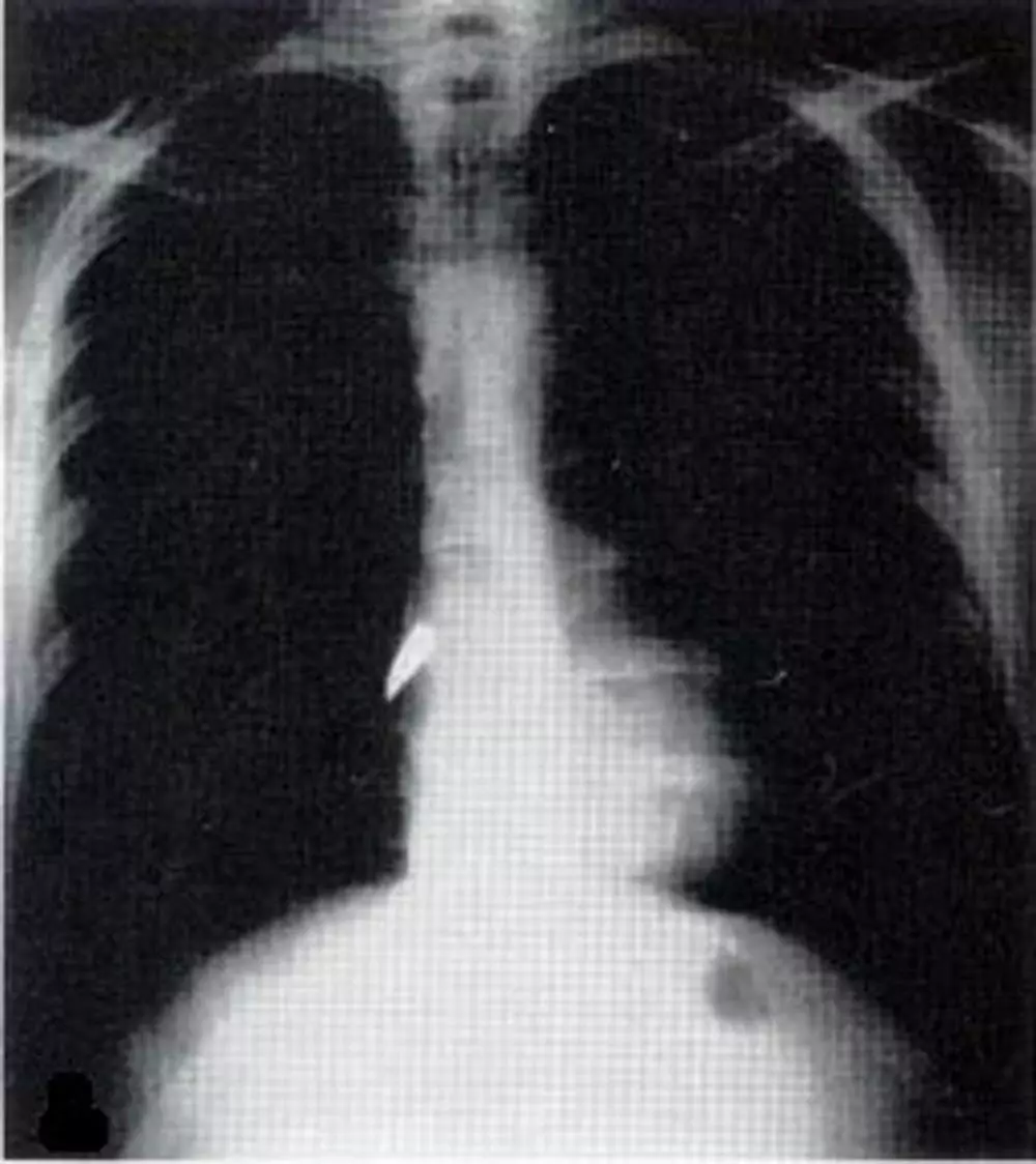 一颗子弹在心脏的 X 光片