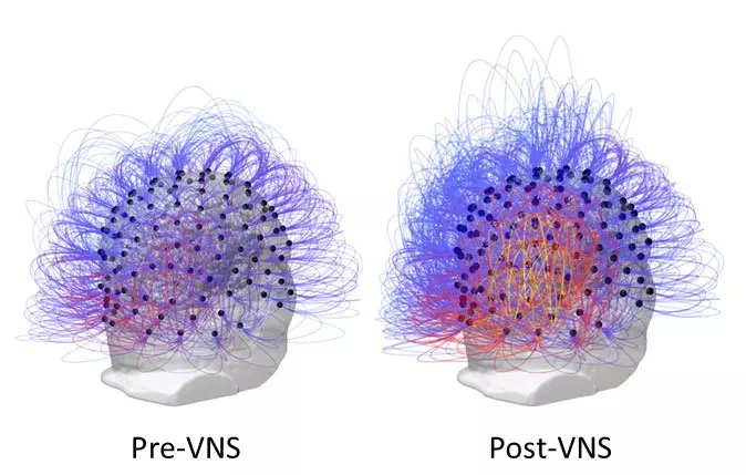 Experimental Treatment Partially Awakens Man in Vegetative State