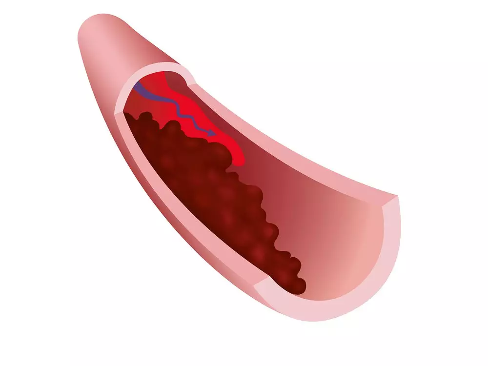 Por qué los coágulos de sangre son un problema importante en casos graves de covid-19