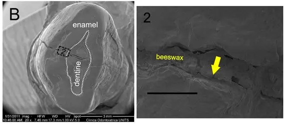 6 500 år gammal bivax kan vara den äldsta kända tandfyllningen