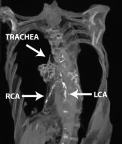 Ang pag-calcification sa tuo (RCA) ug wala (LCA) coronary arteries makita nga puti niini nga CT scan