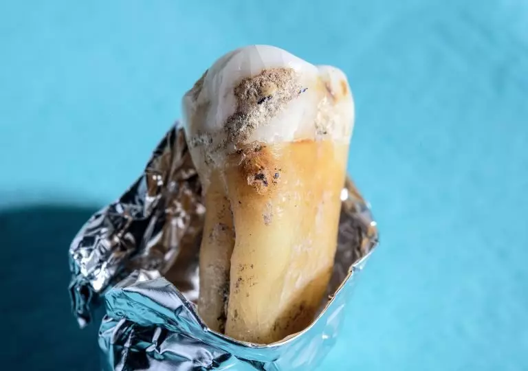 απολιθωμένη πλάκα σε αρχαίο ανθρώπινο δόντι