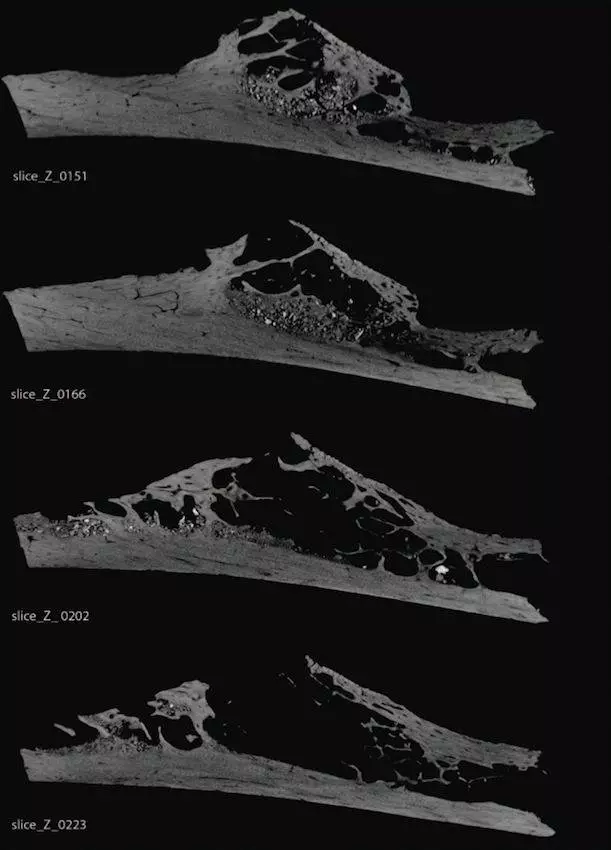 Ipinapakita ng CT scan ng rib bone ang lukab na naiwan ng tumor.