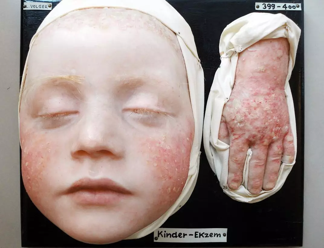 Vaadake selles Šveitsi meditsiinilise moulage muuseumis üle 2000 nahahaiguste vahamudeli 33112_10