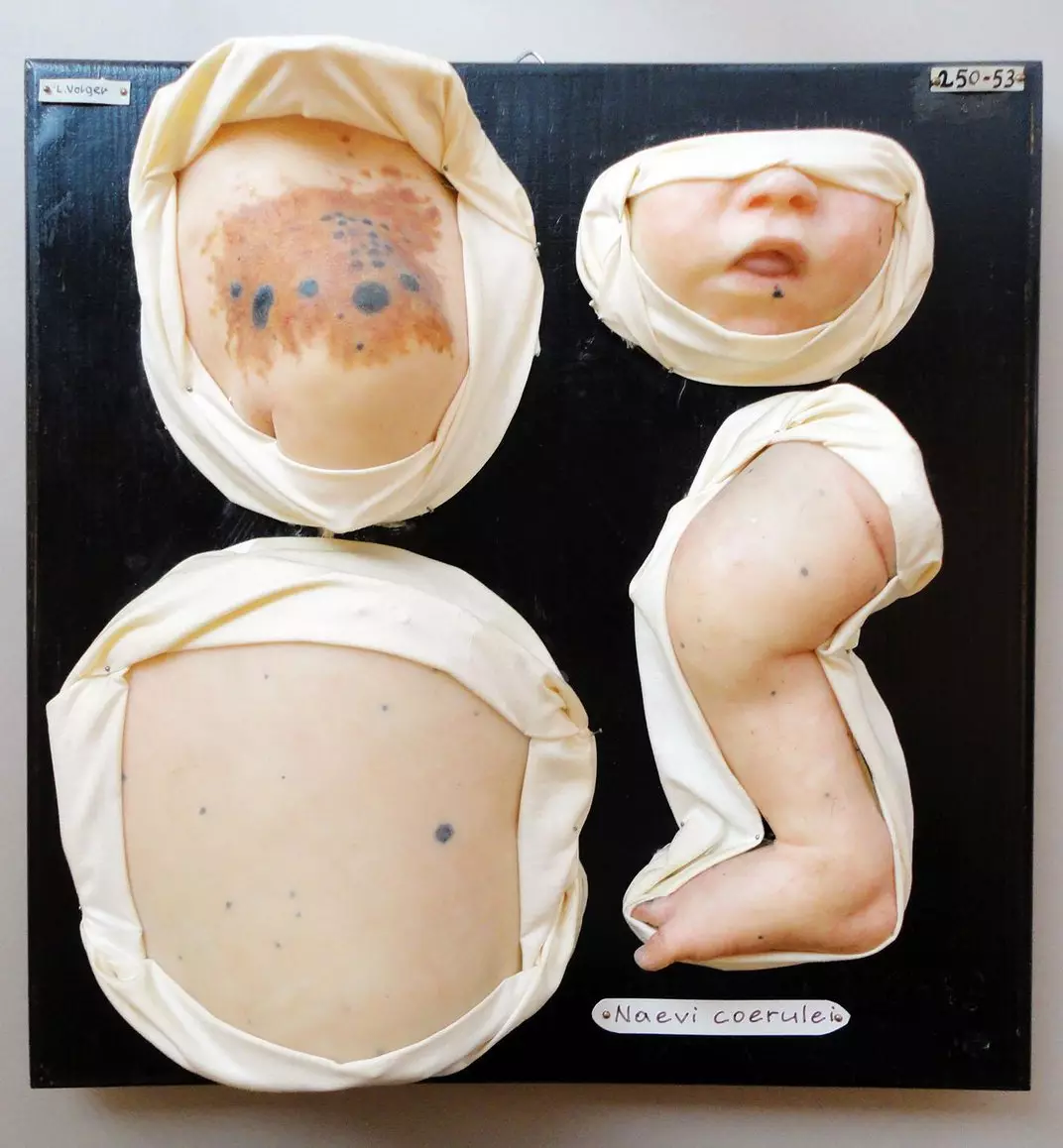 Vaadake selles Šveitsi meditsiinilise moulage muuseumis üle 2000 nahahaiguste vahamudeli 33112_4