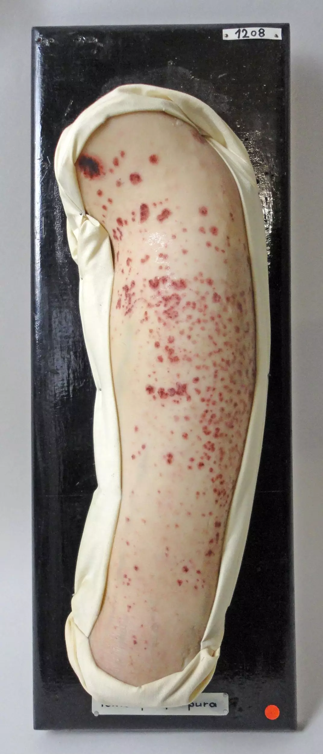 इस स्विस मेडिकल मॉलेज संग्रहालय में त्वचा रोगों के 2,000 से अधिक मोम मॉडल देखें 33112_5