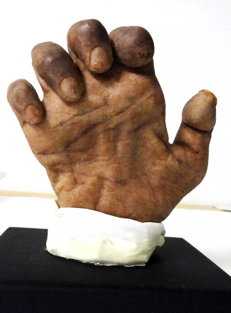 بیش از 2000 مدل مومی از بیماری های پوستی را در این موزه مولاژ پزشکی سوئیس ببینید 33112_6