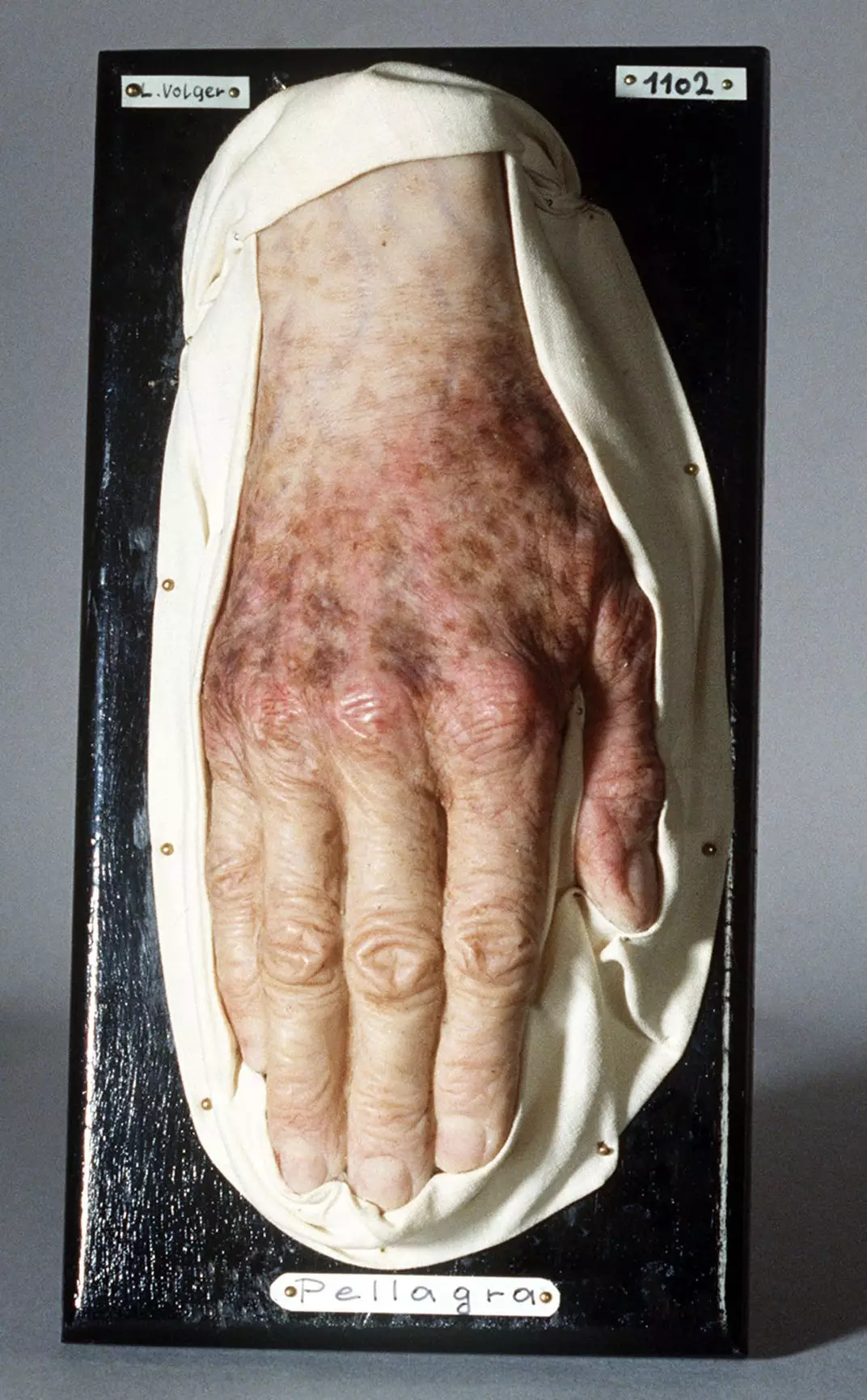 इस स्विस मेडिकल मॉलेज संग्रहालय में त्वचा रोगों के 2,000 से अधिक मोम मॉडल देखें 33112_7