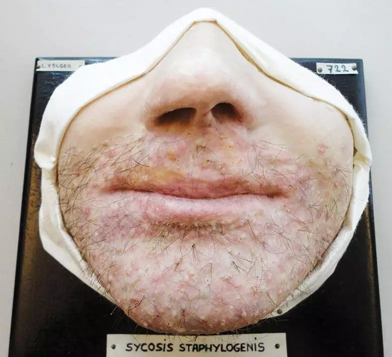 このスイスの医療ムラージュ博物館で皮膚病の2,000以上のワックスモデルを参照してください 33112_9