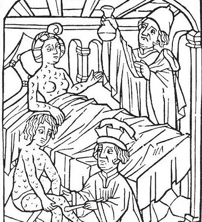 התיאור המוקדם ביותר הידוע של חולים הסובלים מעגבת, מוינה ב-1498.