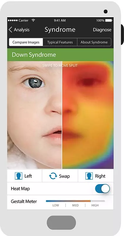 Dizze app brûkt software foar gesichtsherkenning om genetyske betingsten te identifisearjen