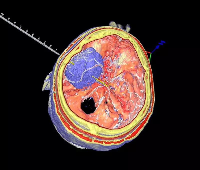 In che modo la chirurgia cerebrale è come volare? Indossa un auricolare per scoprirlo