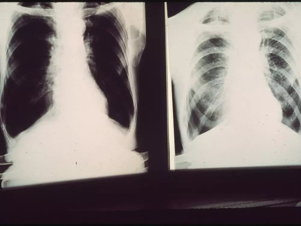 Rentgenska slika črnih pljuč
