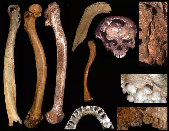 Bidrog voldsom indavl til tidlige menneskers høje forekomst af skeletdeformiteter?