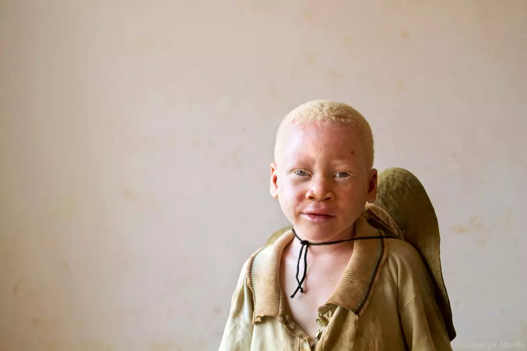 Inda Albinism ke nufin ana Nufin Kisa ko Rarrabu 50031_5