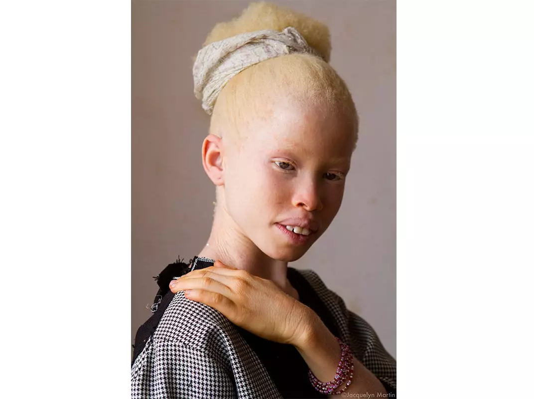 Ki kote albinism vle di ke yo te vize pou touye moun oswa demantelman 50031_7