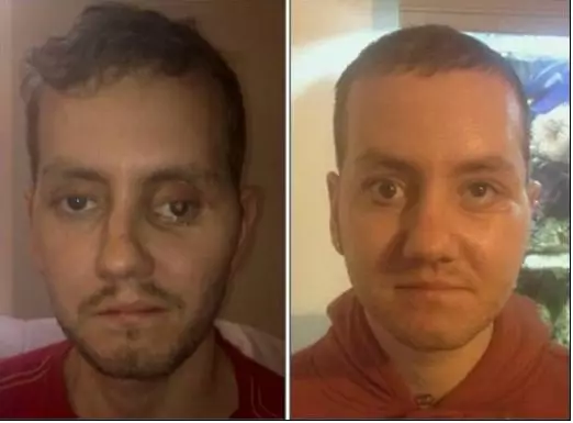 3D 프린팅이 이 남자의 얼굴을 수리하는 데 도움이 된 방법