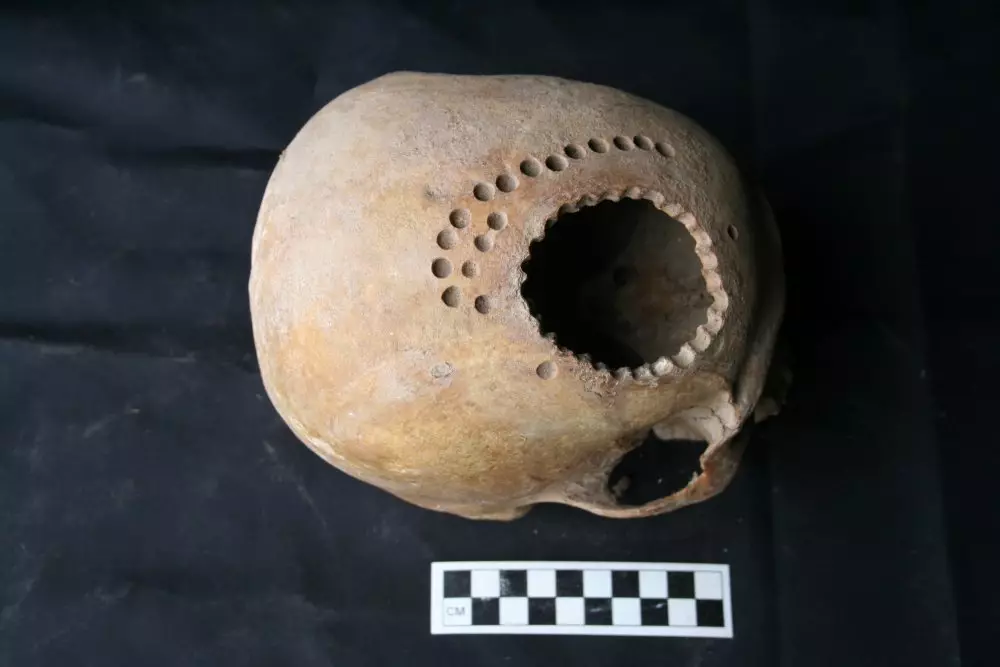 Пред 1.000 години, пациентите преживеале операција на мозокот, но морале да живеат со огромни дупки во главите