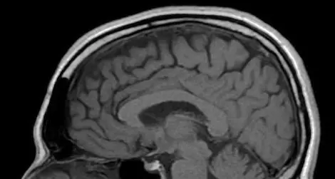 Bir Sarsıntıdan Dört Ay Sonra Beyniniz Hala Eskisinden Farklı Görünüyor
