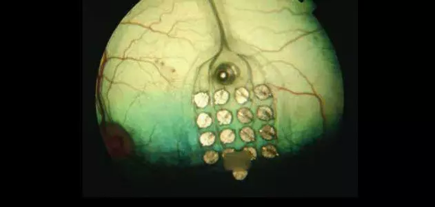 Novi uređaj digitalno projektuje Brajevu azbuku direktno na retinu slijepog pacijenta 9602_1
